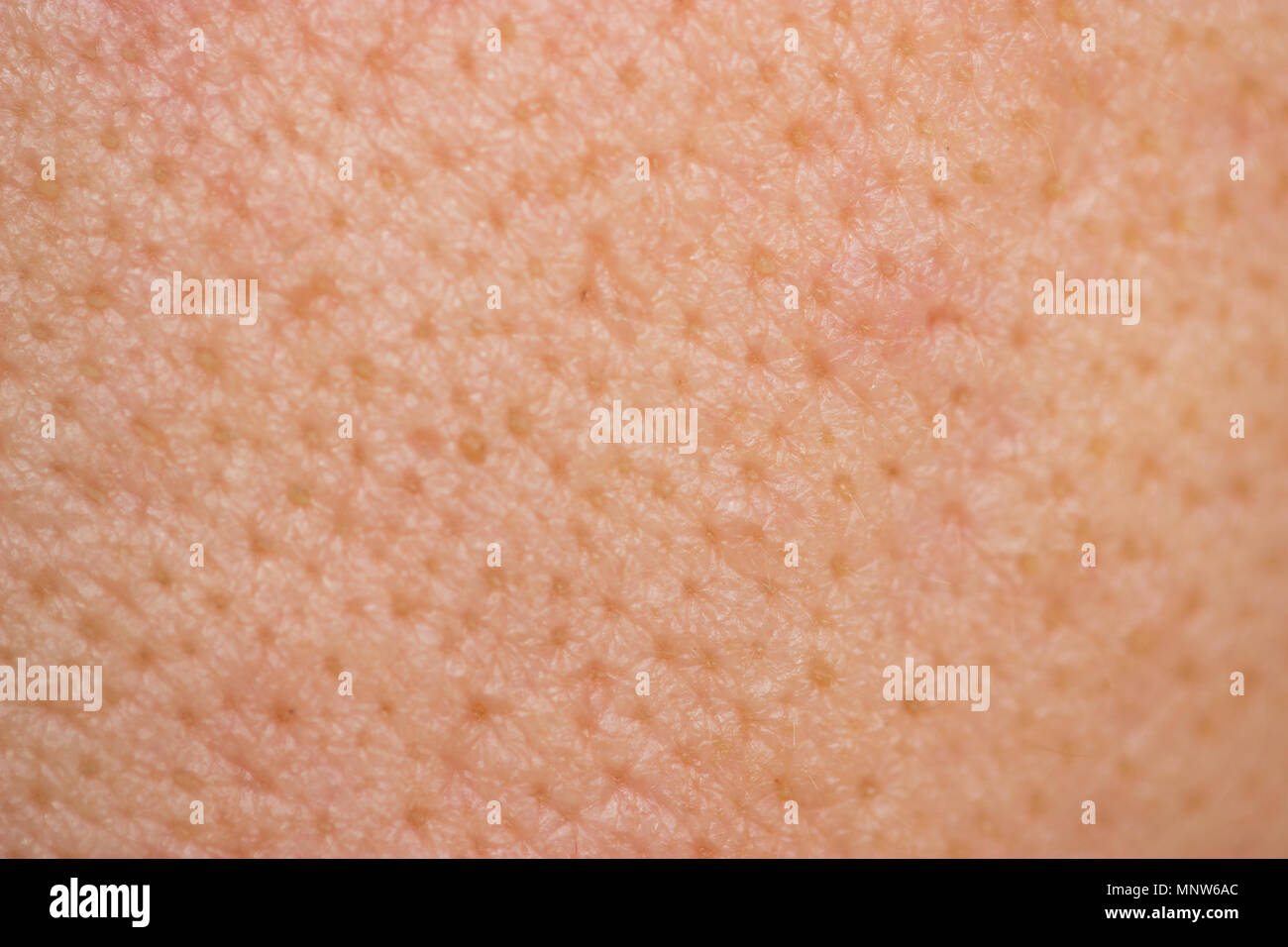 Acne skin on face woman,problem skin. macro Stock Photo - Alamy