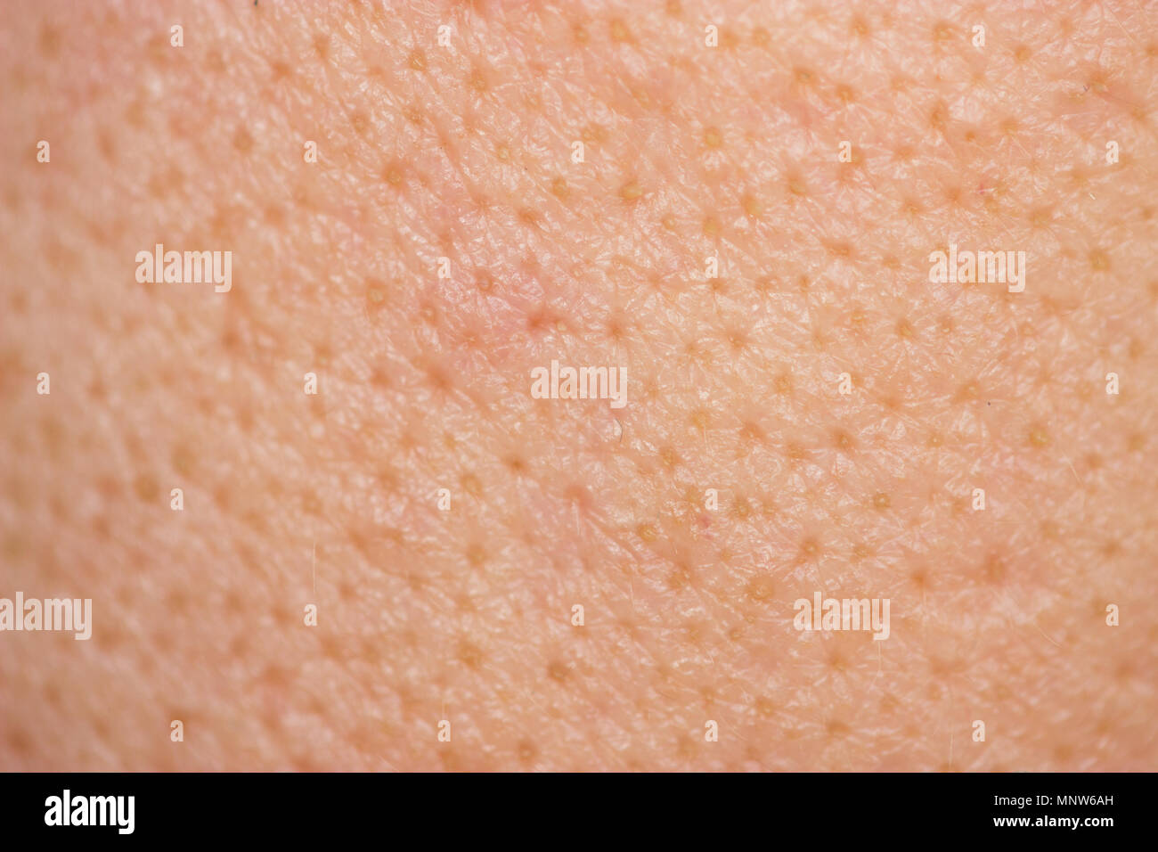 Acne skin on face woman,problem skin. macro Stock Photo - Alamy