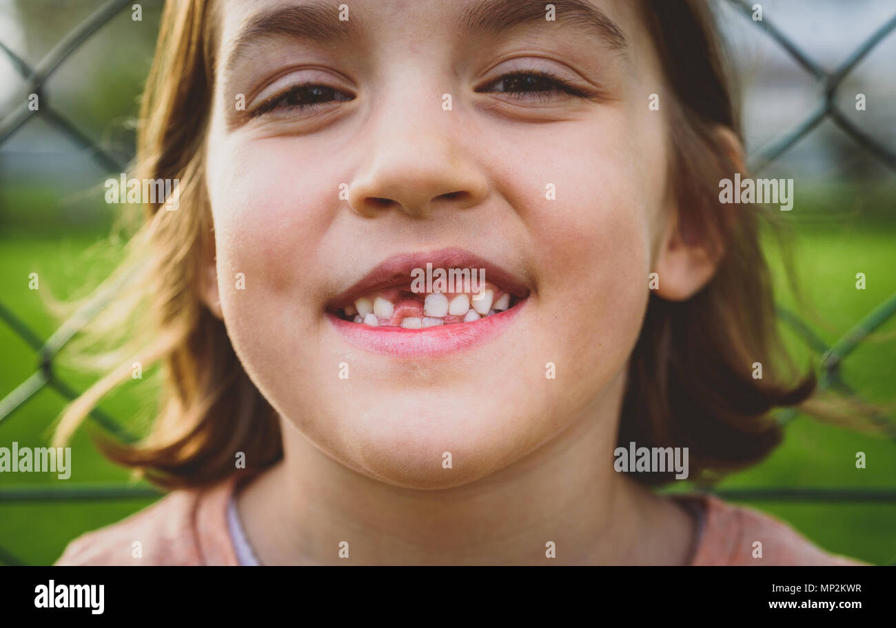 Portrait of toothless child girl missing milk and permanent teeth ...
