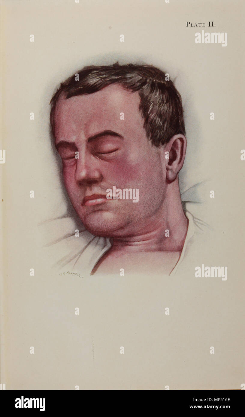 Asphyxia hi-res stock photography and images - Alamy