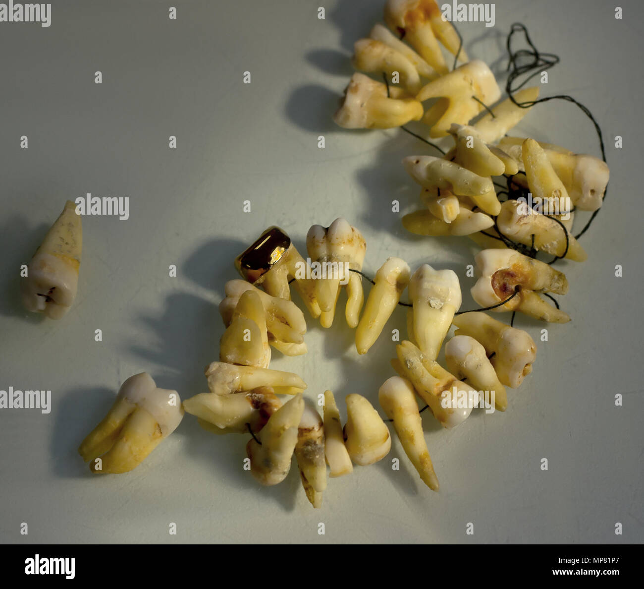 Dental caries hi-res stock photography and images - Alamy
