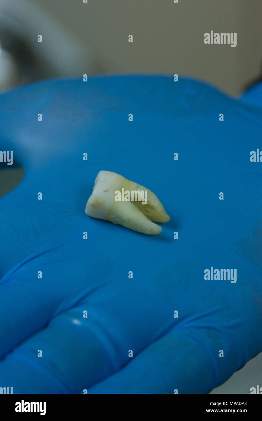Taken out a tooth in his hand at the dentist Stock Photo - Alamy