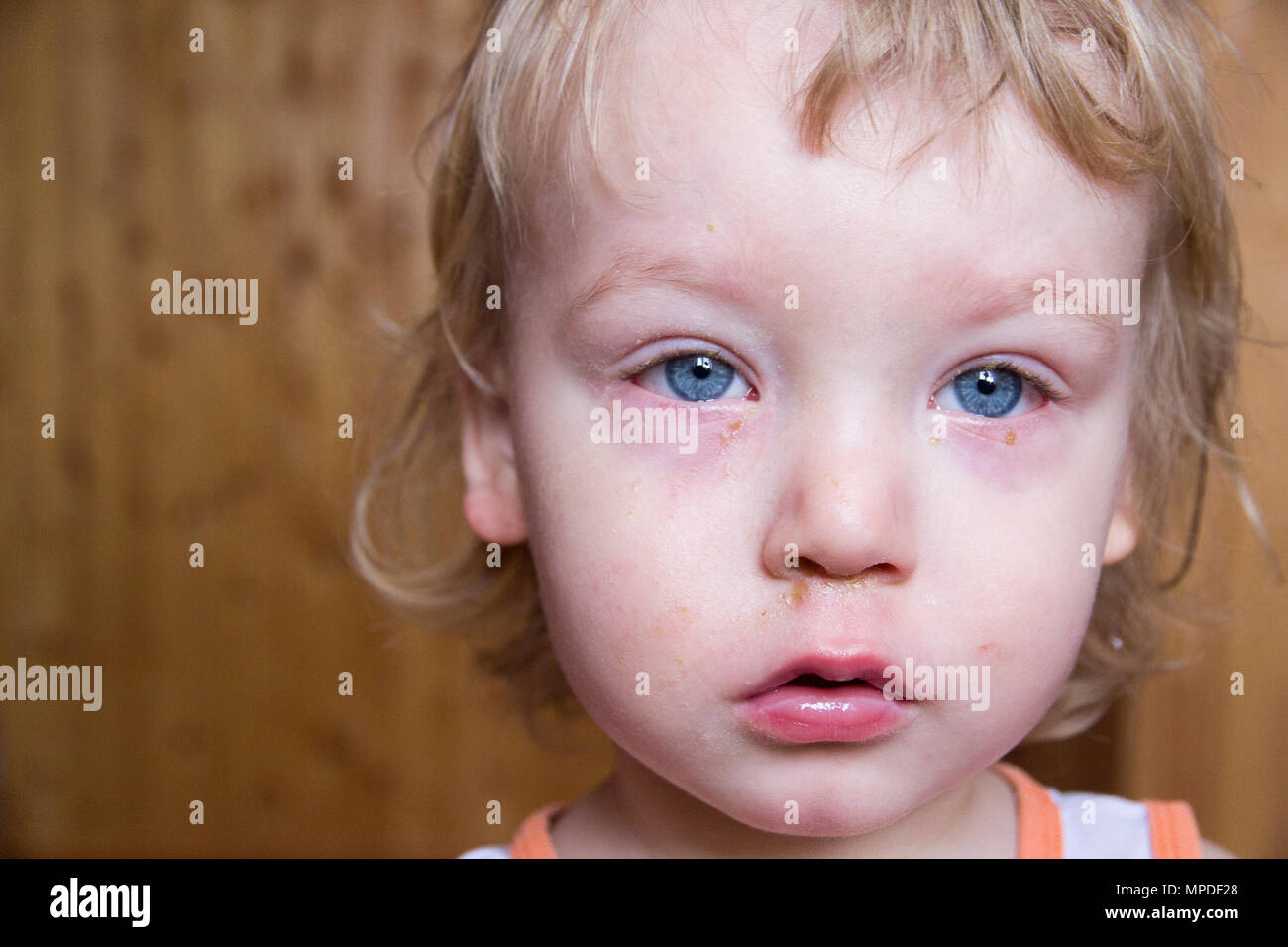 Little boy with blond hair and blue eyes suffering from disease ...