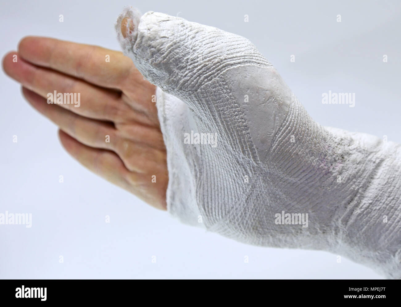 Man's hand in the emergency room after the fracture of the thumb due to ...