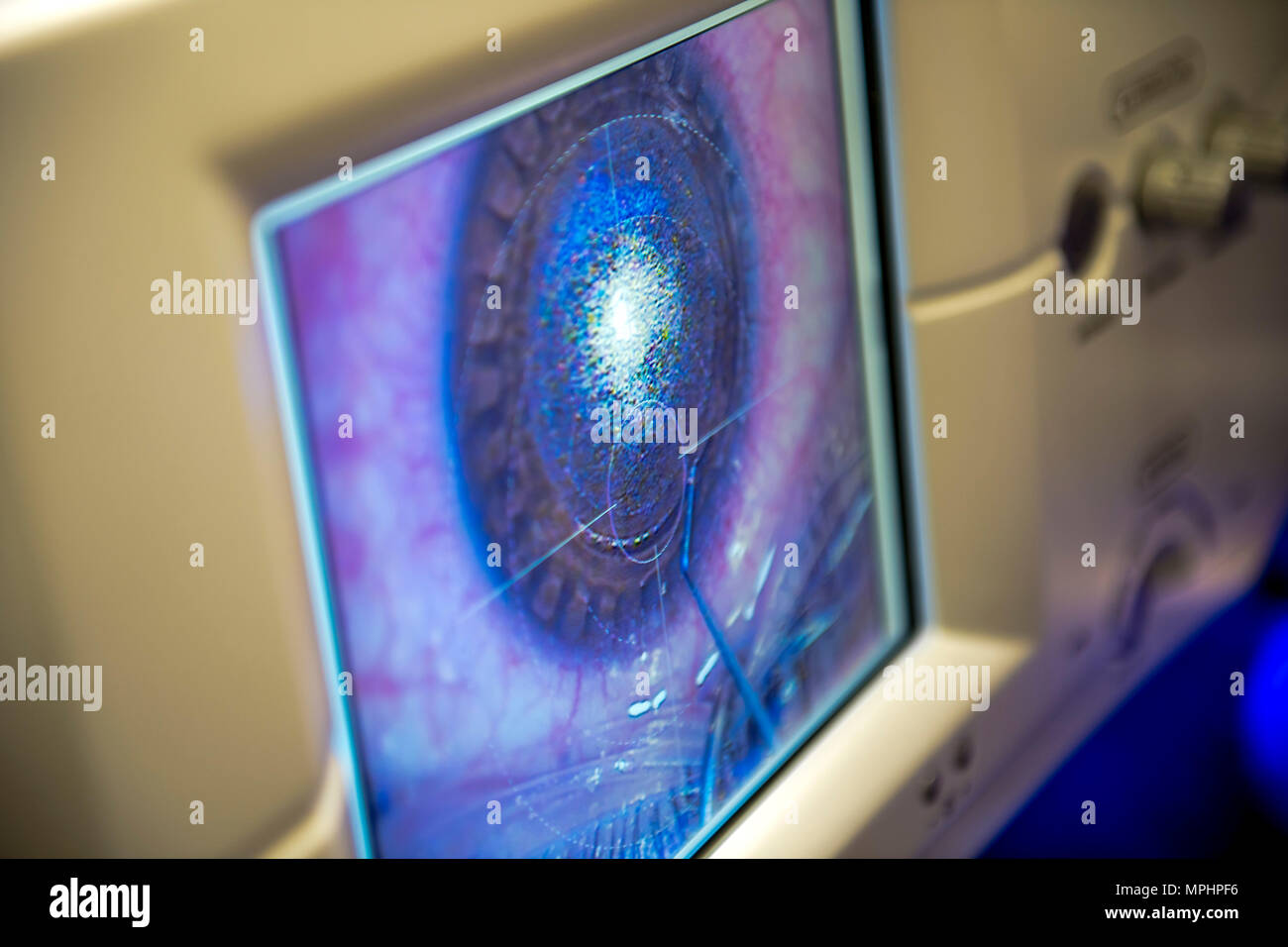 FORT BELVOIR, Va. (March 16, 2017) The Warfighter Refractive Eye ...