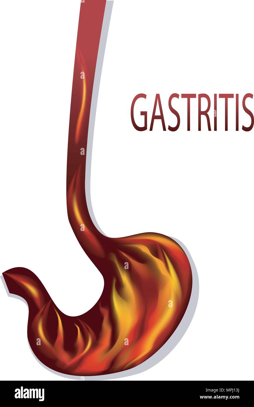 Gastritis vector vectors hi-res stock photography and images - Alamy