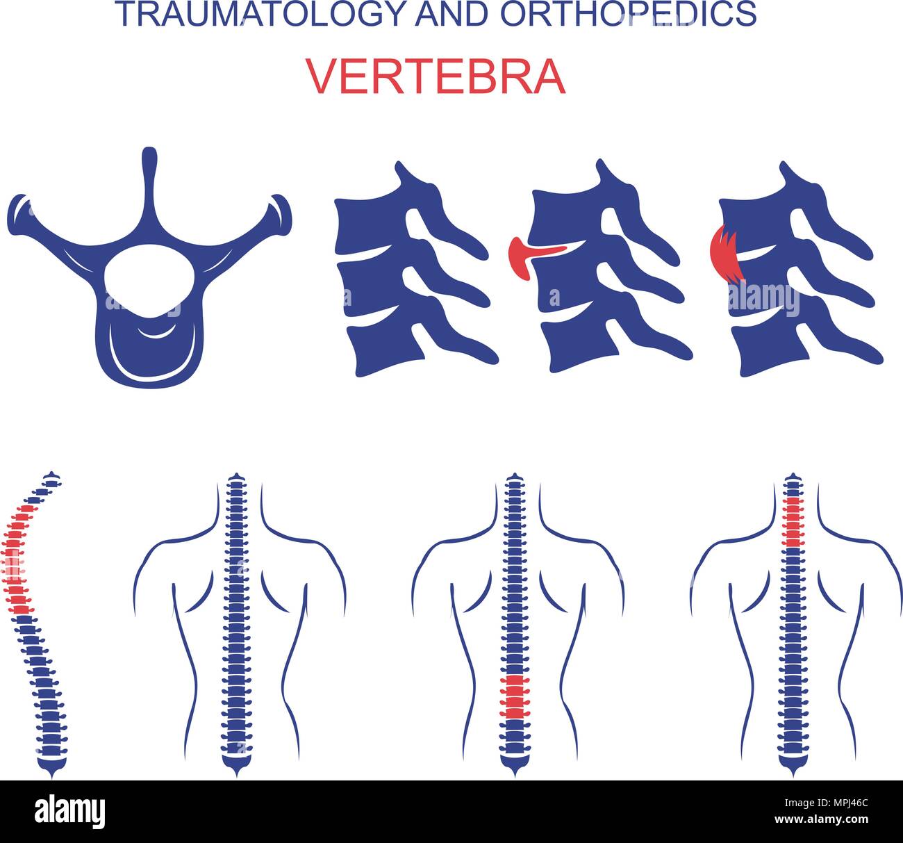 Illustration of the spine, vertebra, vertebral hernia, sprains ...
