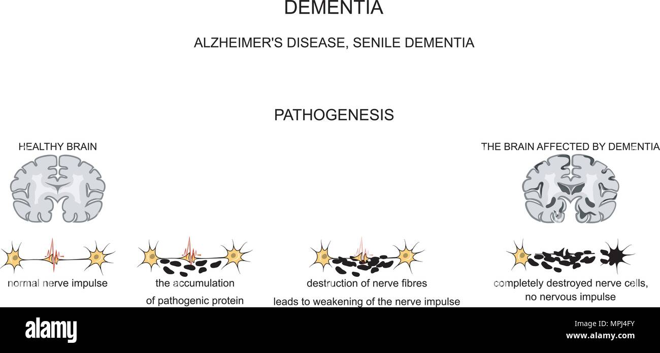 Brain alzheimer disease Stock Vector Images - Alamy