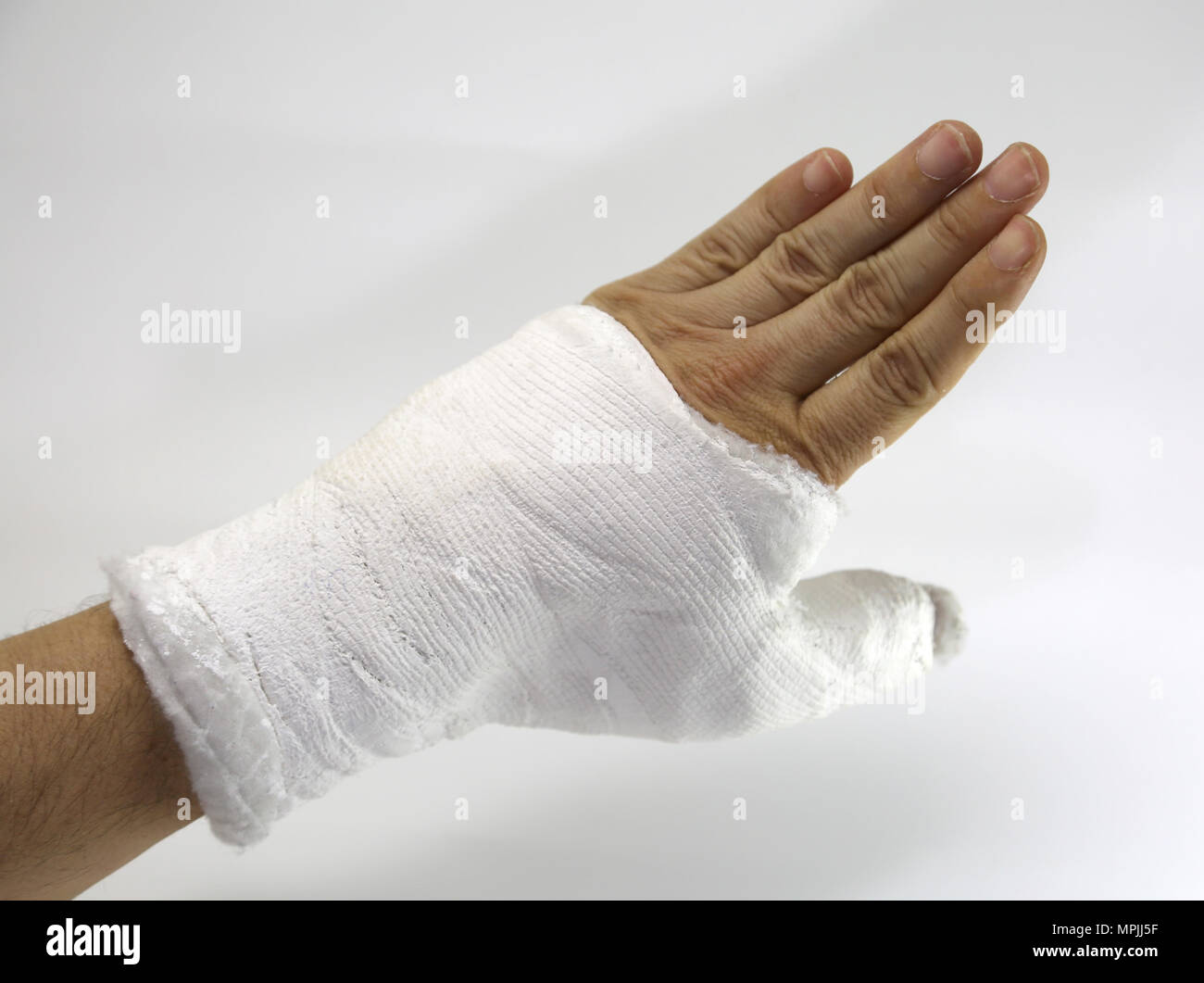 Hand cast fractured after a serious car accident Stock Photo - Alamy