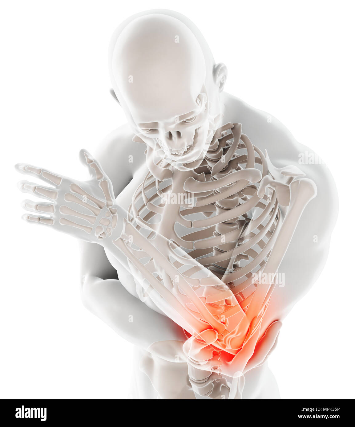 3d illustration of human elbow injury, medical concept Stock Photo - Alamy