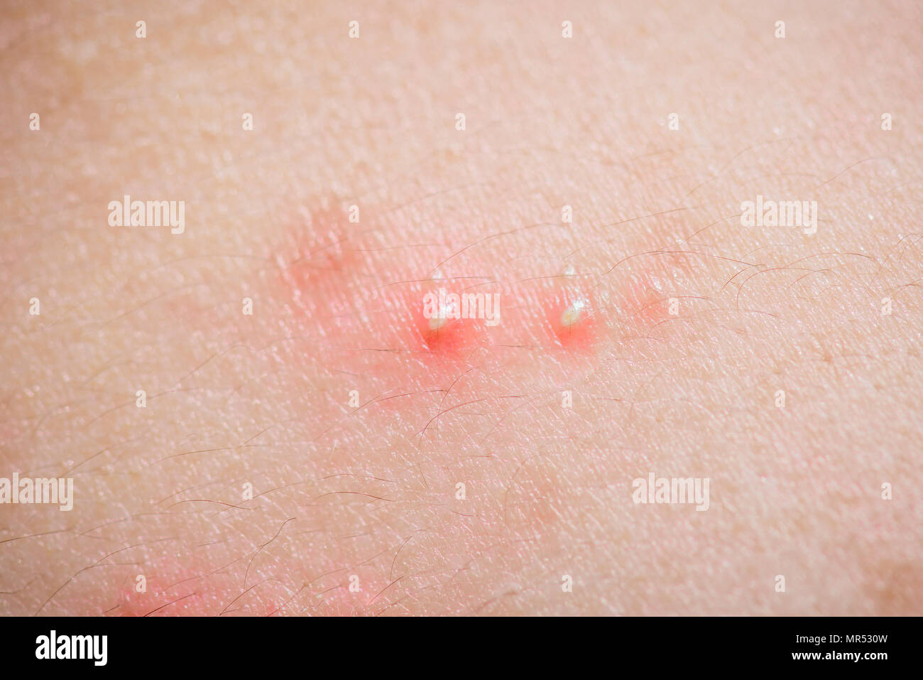 Melanoma scar hi-res stock photography and images - Alamy