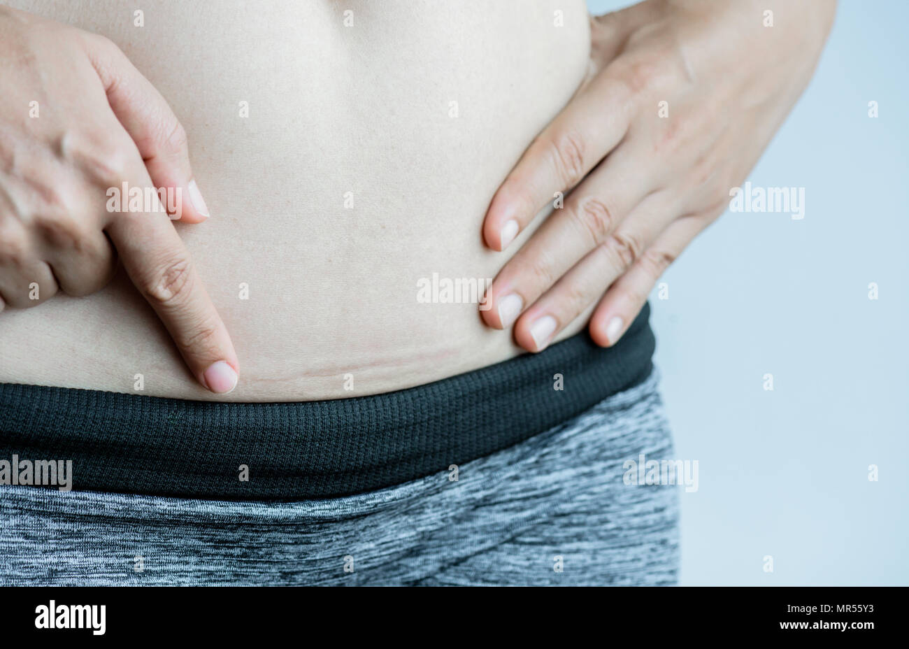 Appendix scar hi-res stock photography and images - Alamy