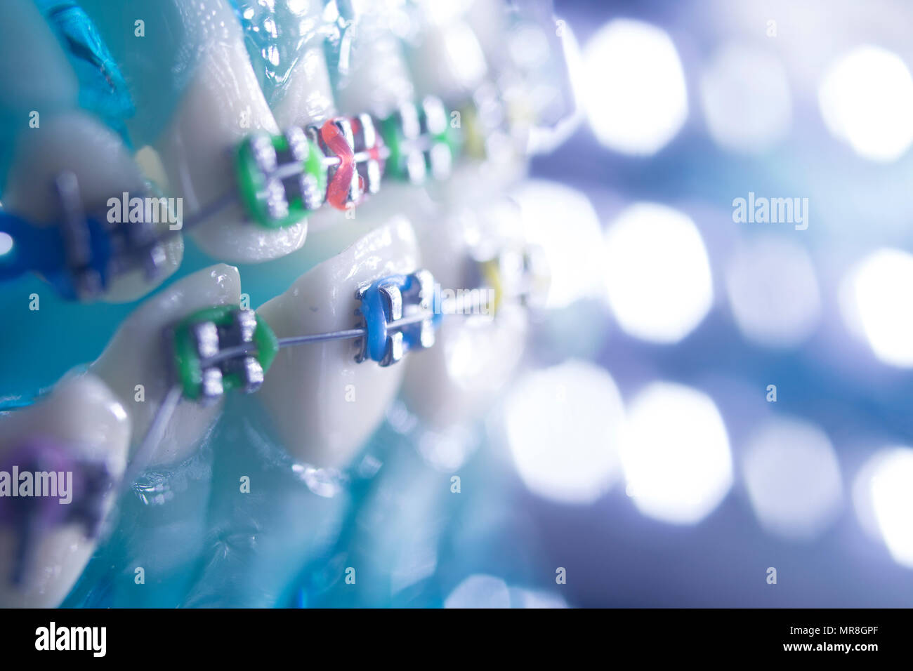 Dental teeth retainers metal aligners brackets to straighten teeth in ...