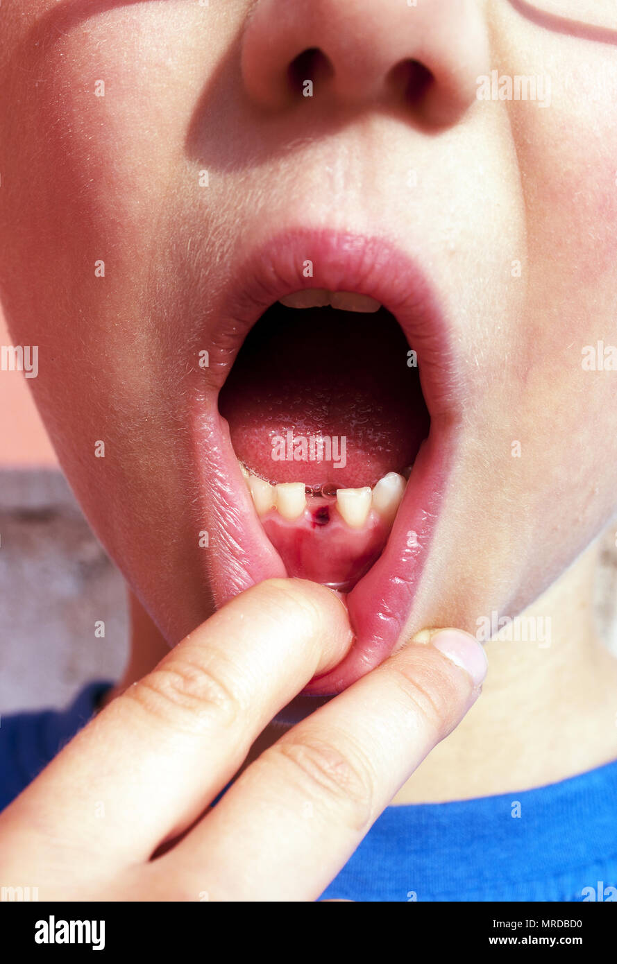 Baby teeth changing hi-res stock photography and images - Alamy