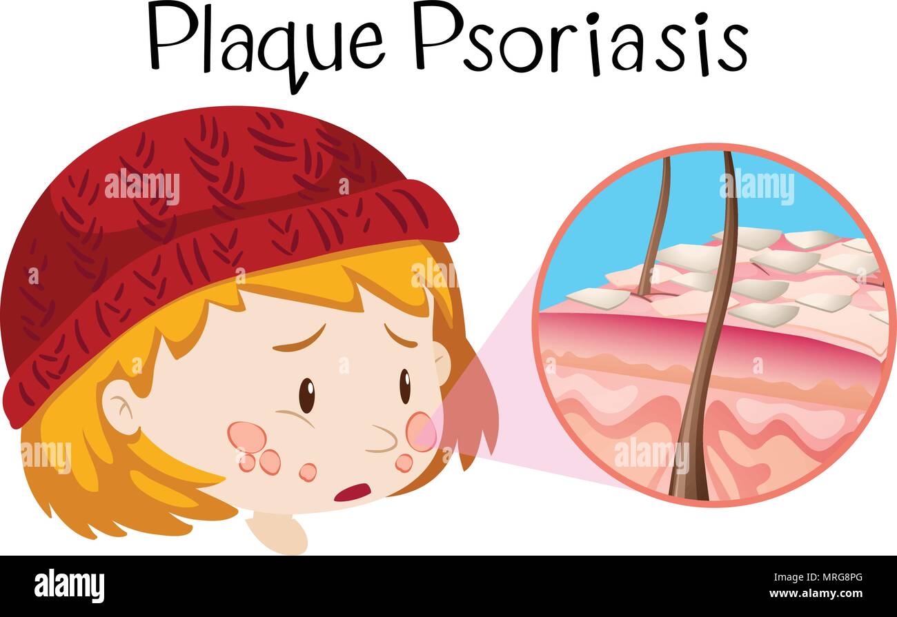 Plaque psoriasis hi-res stock photography and images - Alamy