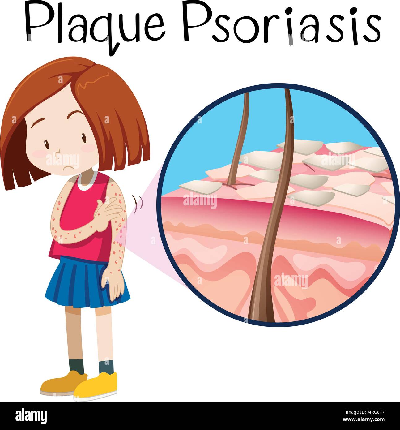 Plaque psoriasis hi-res stock photography and images - Alamy