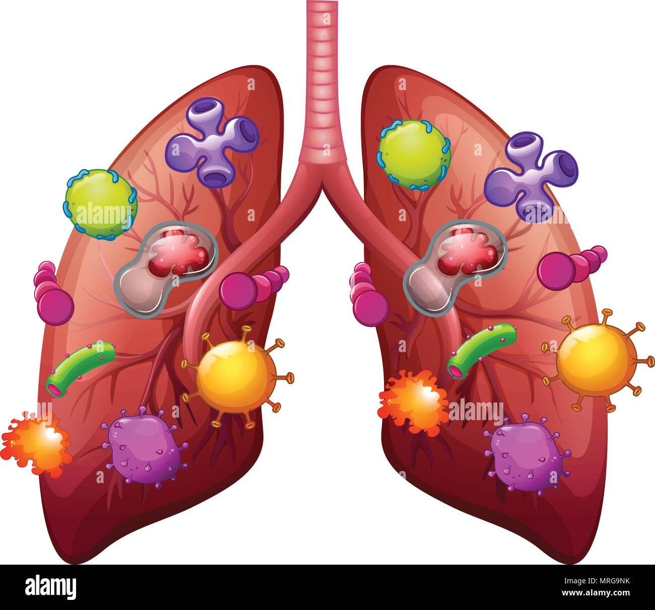 Lungs covered with bacteria illustration Stock Vector Image & Art - Alamy