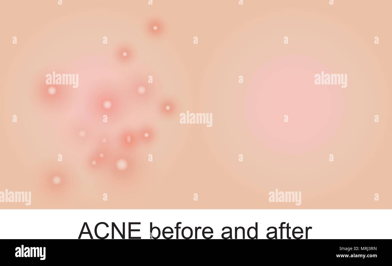 Acne vector vectors hi-res stock photography and images - Alamy