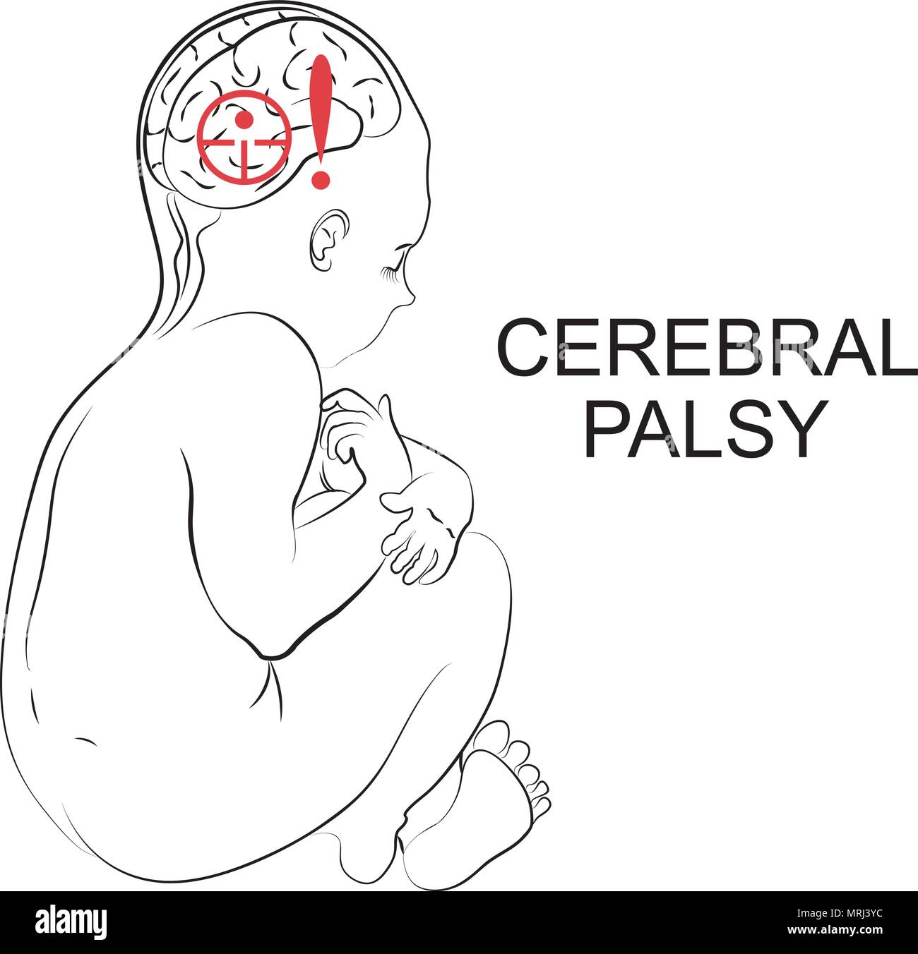 Cerebral palsy child hi-res stock photography and images - Alamy