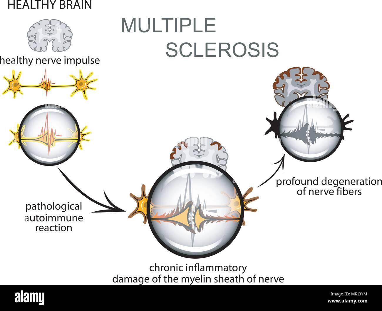 multiple sclerosis. The mechanism of the disease development Stock ...