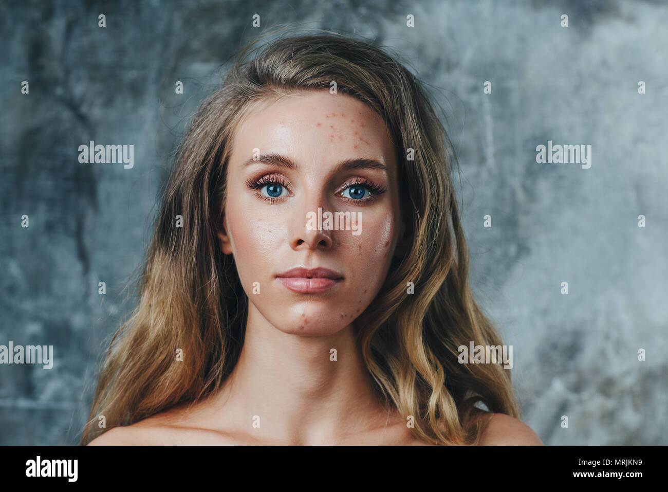 Young woman allergy and acne on face front portrait on gray wall ...