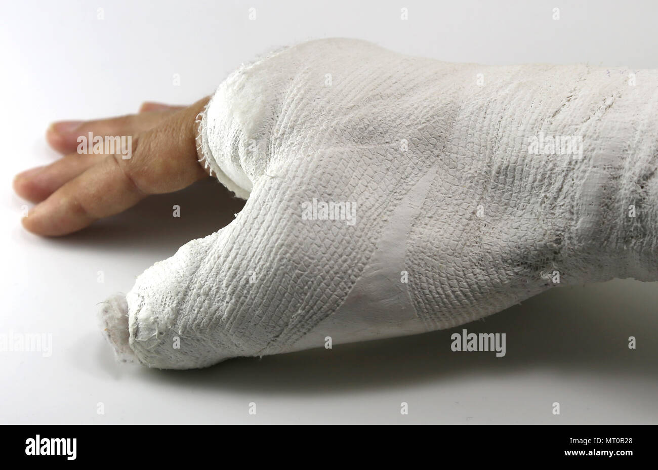 hand of man in the emergency room after the fracture of the thumb due ...