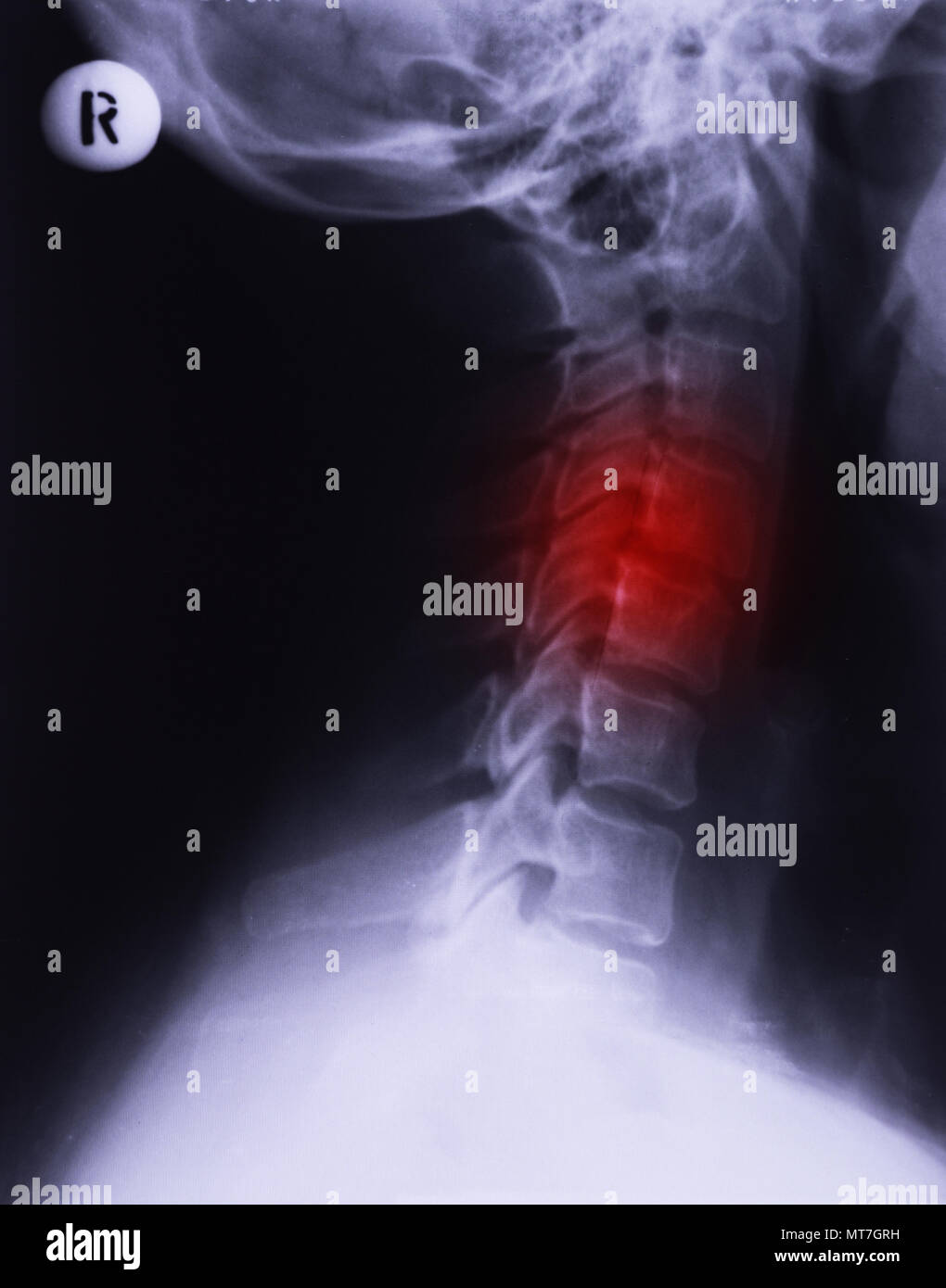 X-ray of neck, lateral projection. Cervical sprain rectification of ...