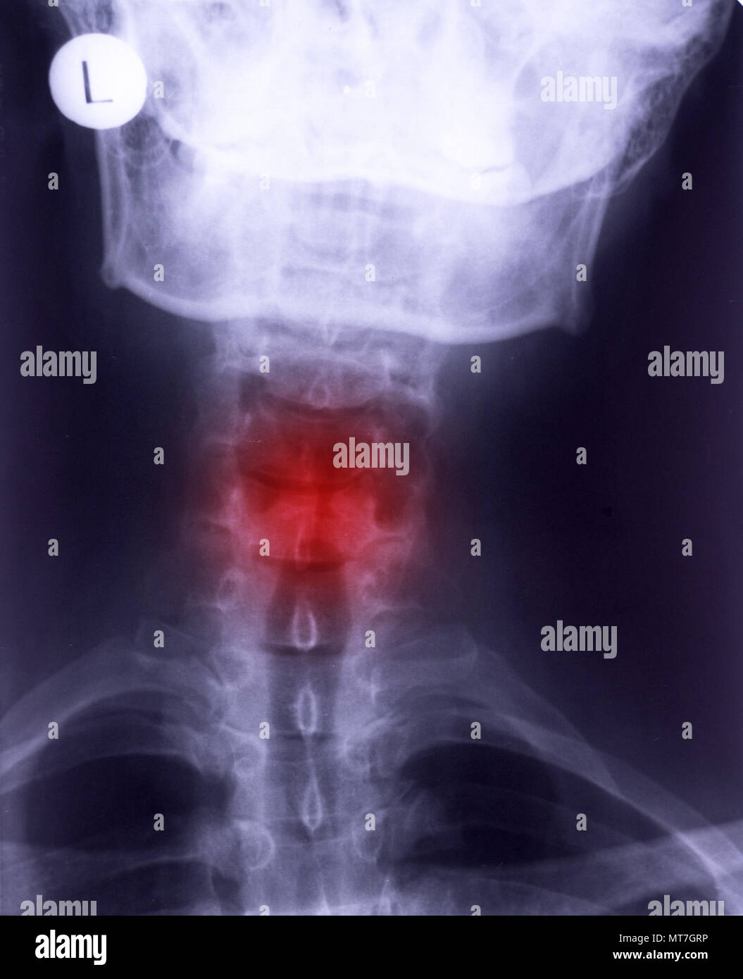 Lordosis X Ray Lordosis Wikipedia