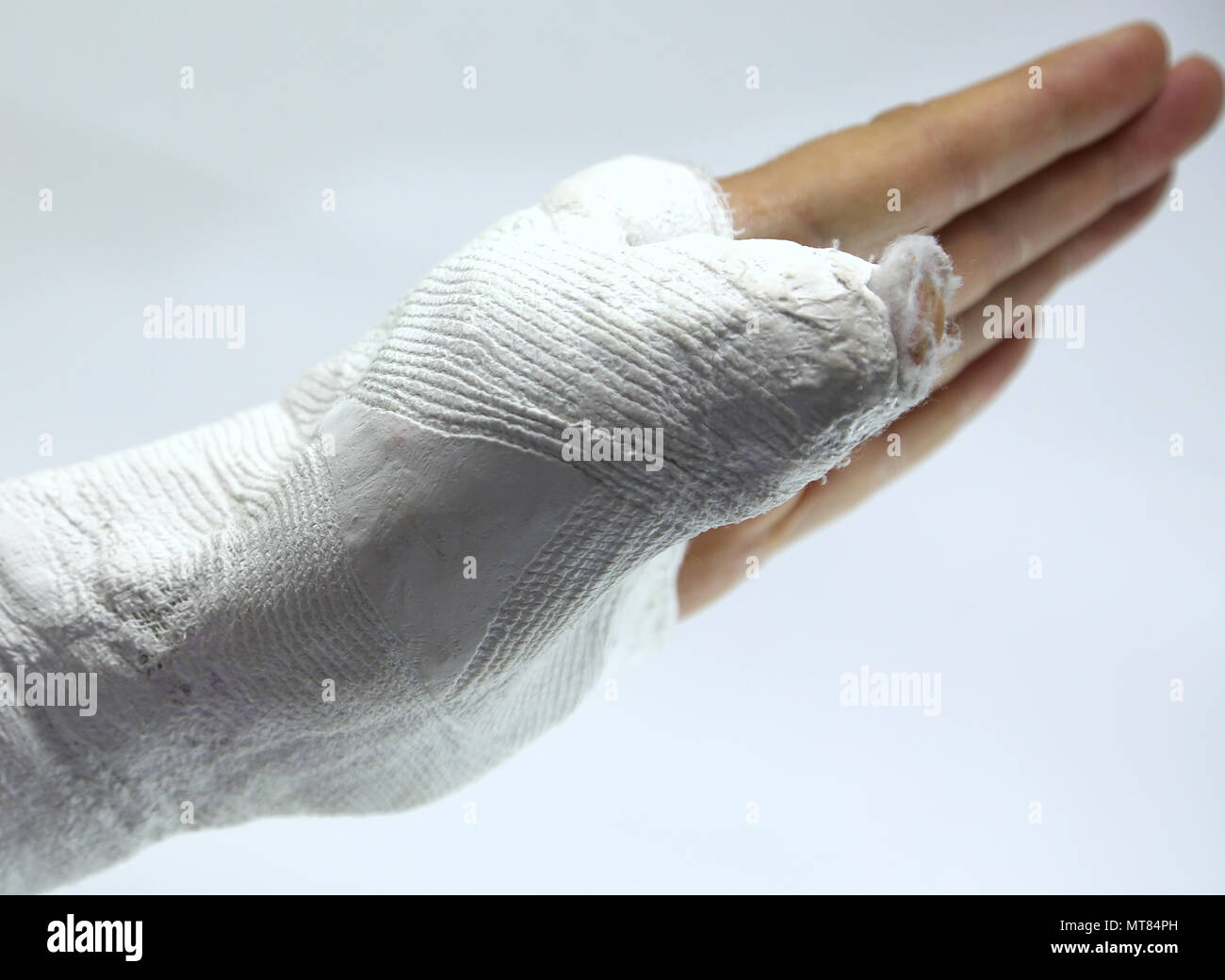 Hand of the injured boy with the broken limb after the car accident ...