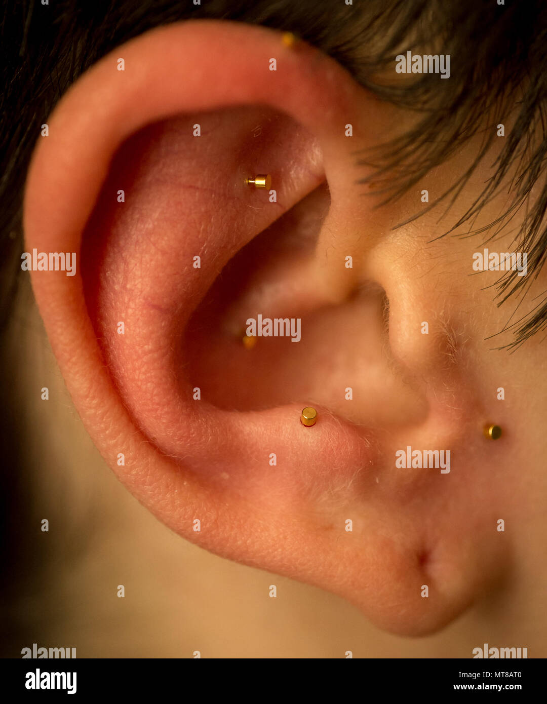 A patient's ear after five needles were inserted by former Air Force ...