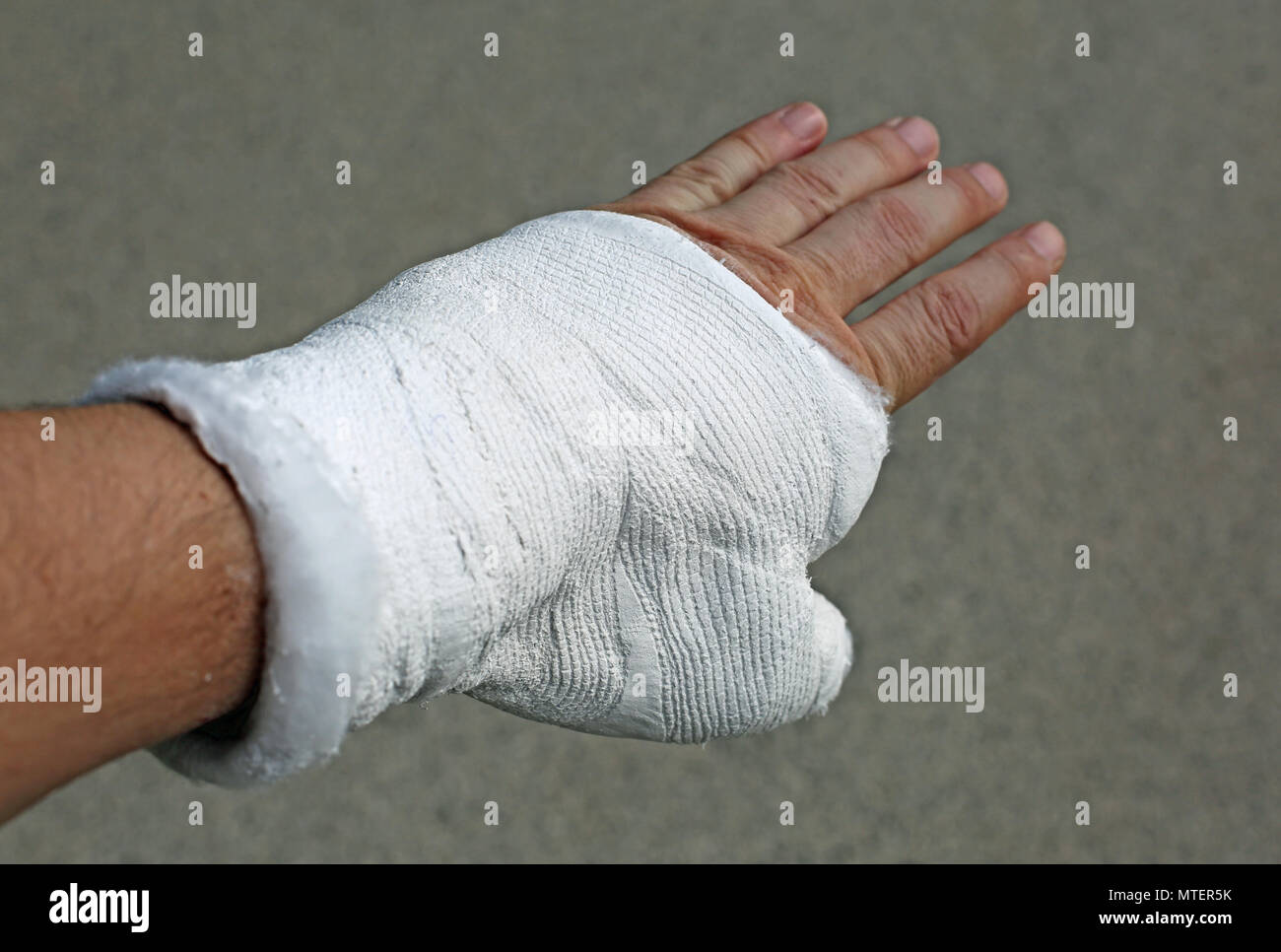 hand with plaster cast after breaking the phalanx Stock Photo - Alamy