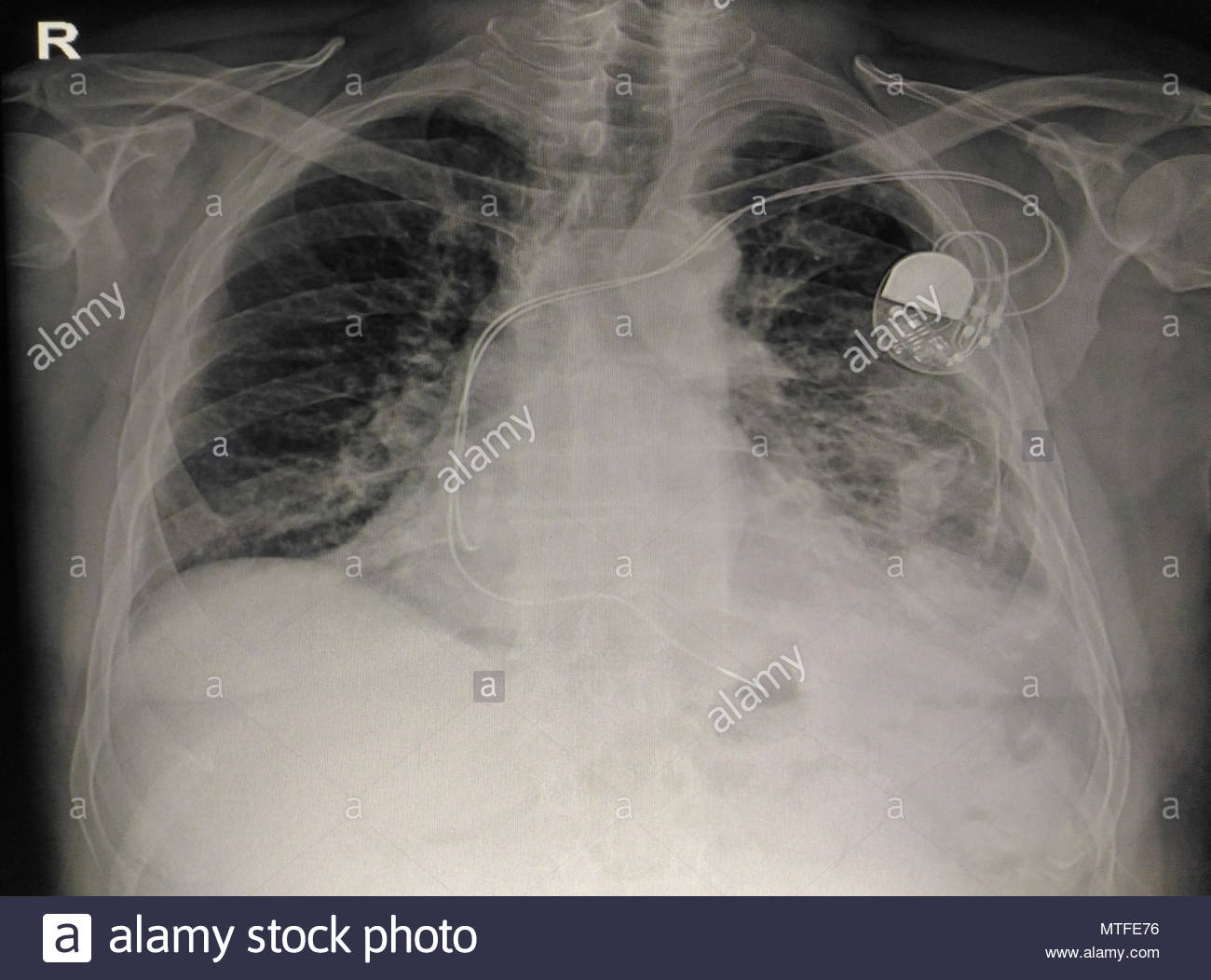 Heart Pacemaker X Ray Stock Photos & Heart Pacemaker X Ray Stock Images ...