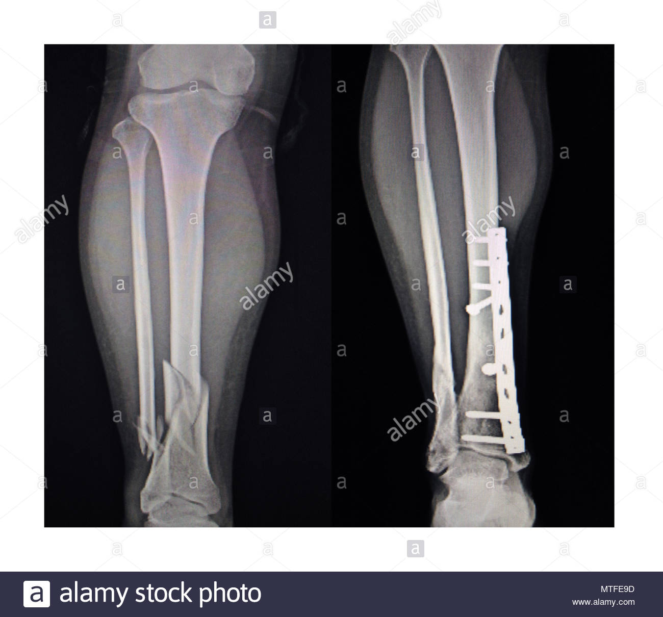 Broken Joint Stock Photos & Broken Joint Stock Images - Alamy