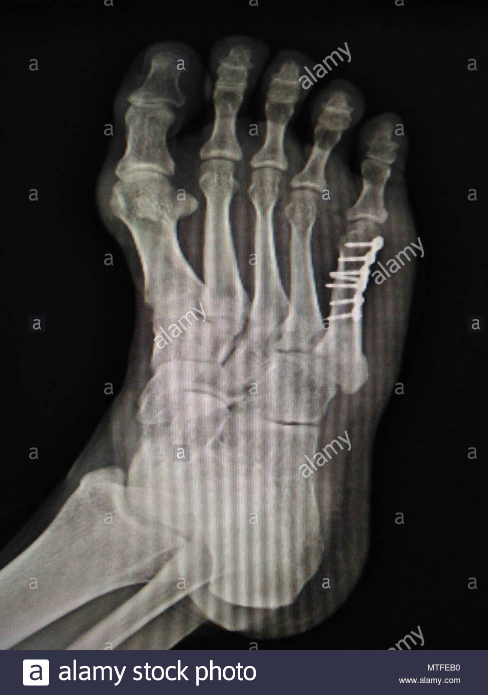 Fracture Of Tibia And Fibula Stock Photos & Fracture Of Tibia And ...