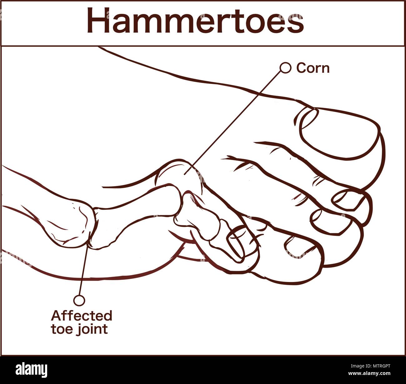 vector illustration of a hammertoes Stock Vector Image & Art - Alamy