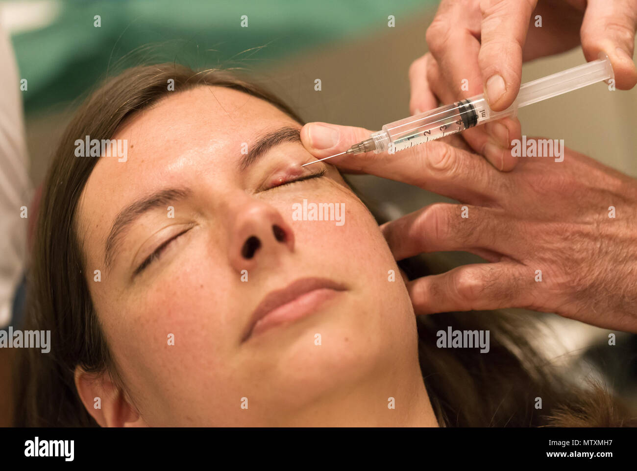 Meibomian abscess hi-res stock photography and images - Alamy