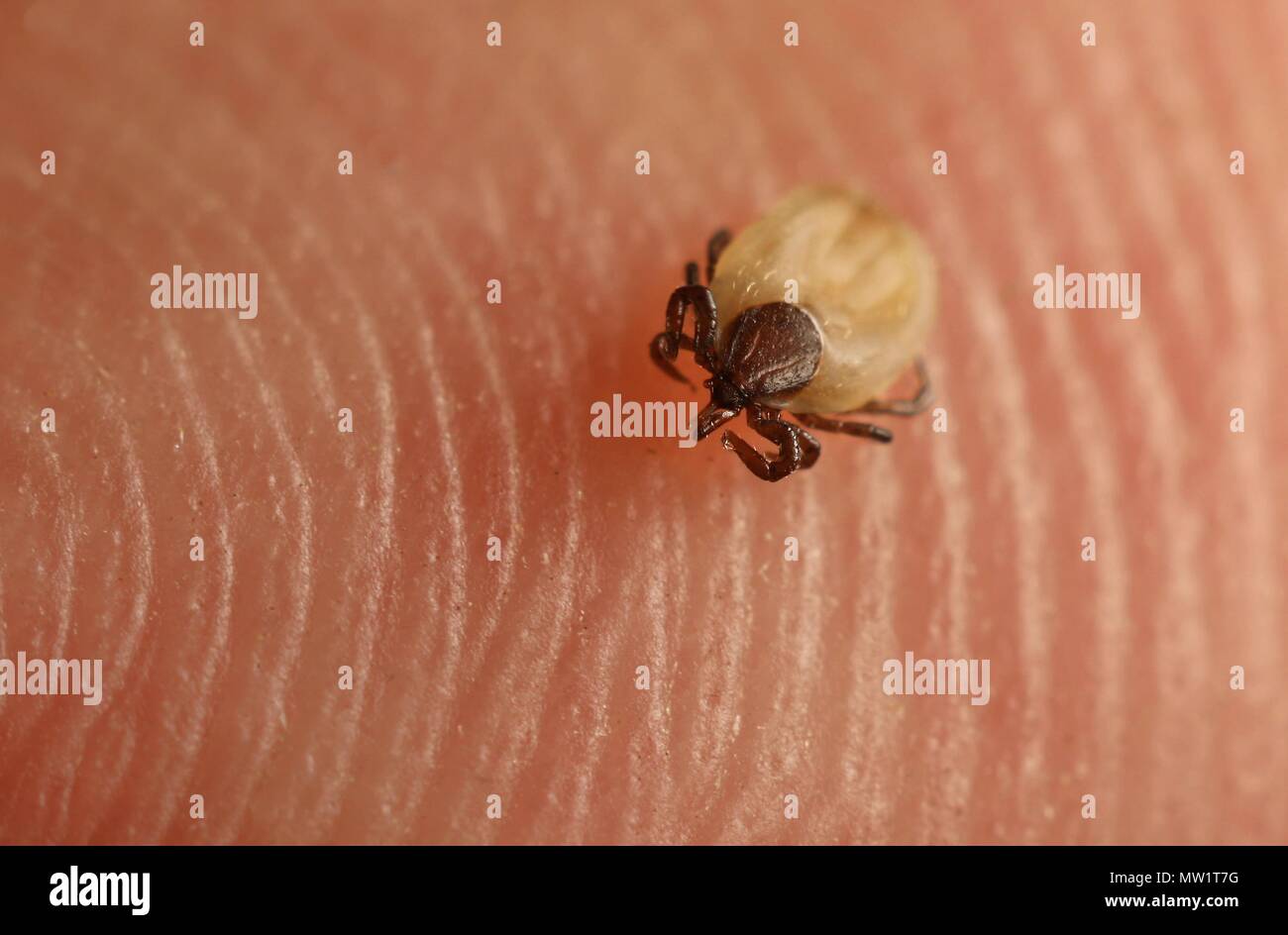 Tick on skin Stock Photo - Alamy