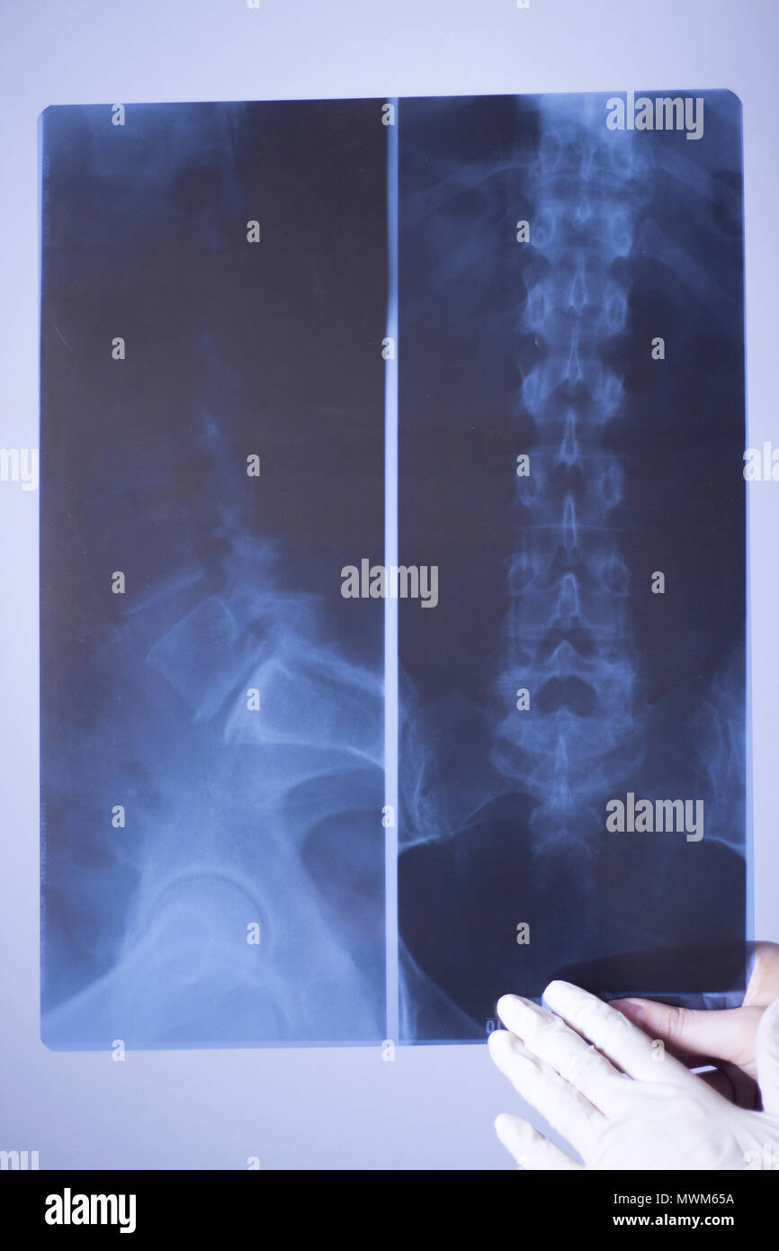 Medical hospital x-ray lowe back pain spine and hips traumatology scan ...