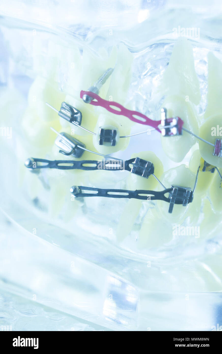 Orthodontics dentists teaching model dental teeth plastic and metal ...