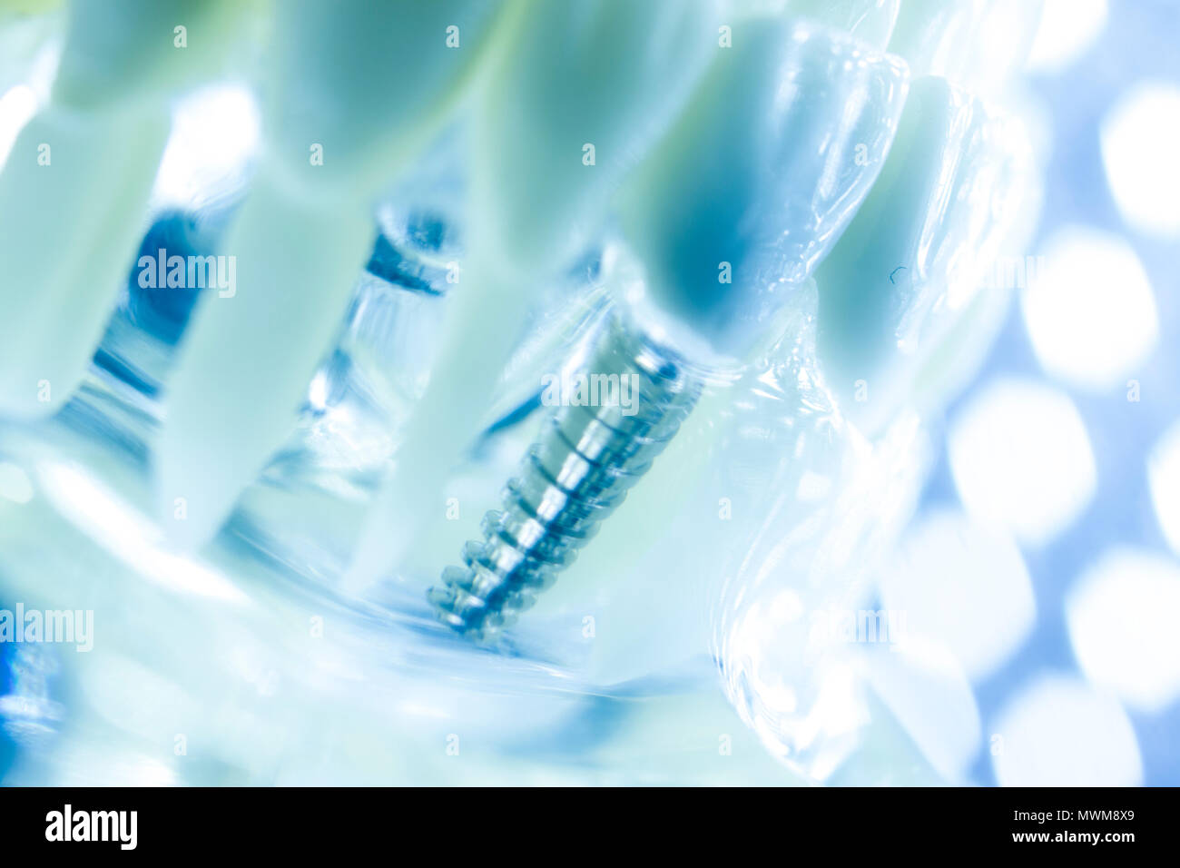 Dental titanium aesthetic orthodontic tooth implant in dentists mouth ...