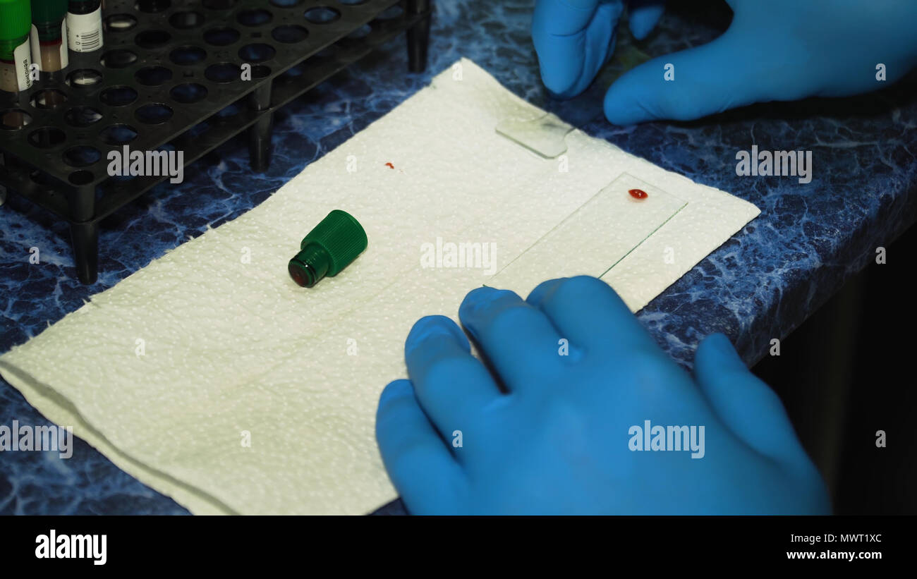 Slide peripheral blood smear method. Doctor examines and analyzes blood ...