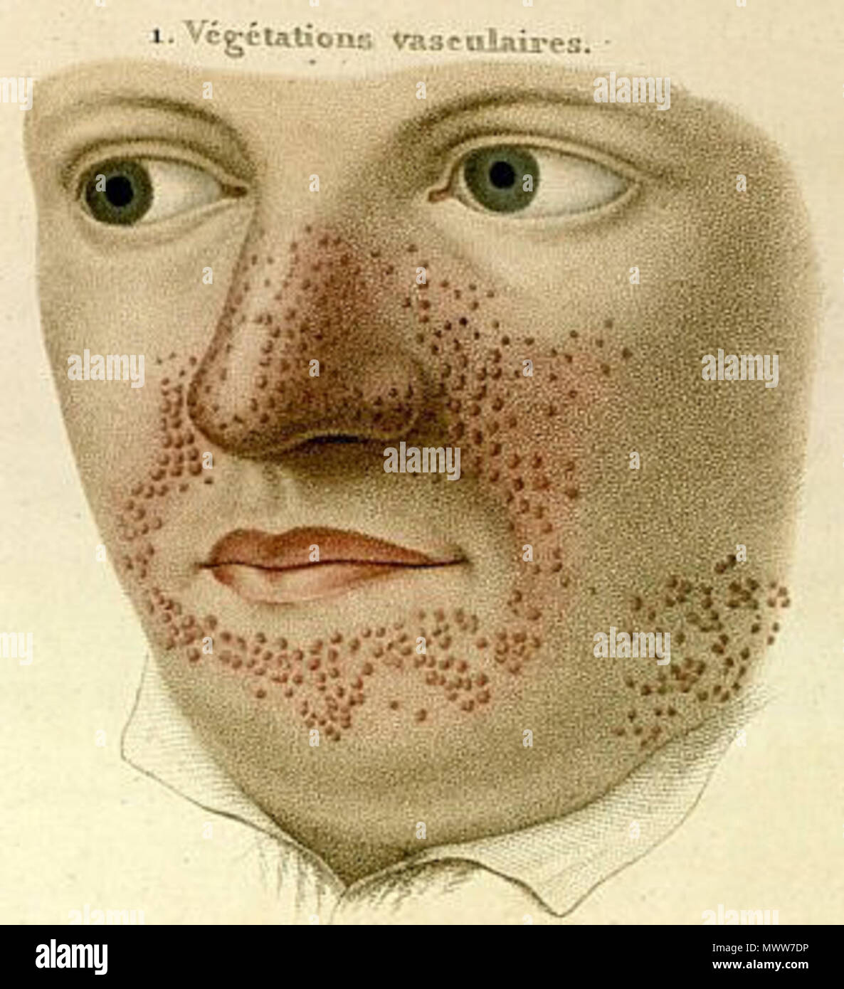 Tuberous Sclerosis Face