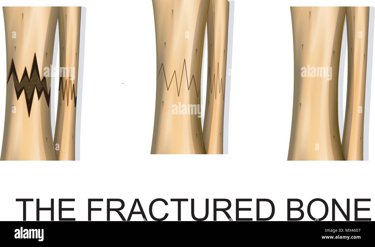 Healing bone Stock Vector Images - Alamy