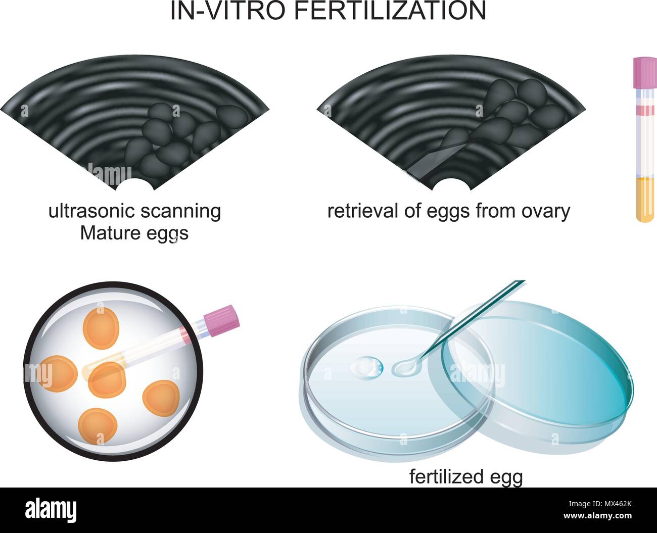 illustration the technology of IVF, ultrasound. vector Stock Vector ...
