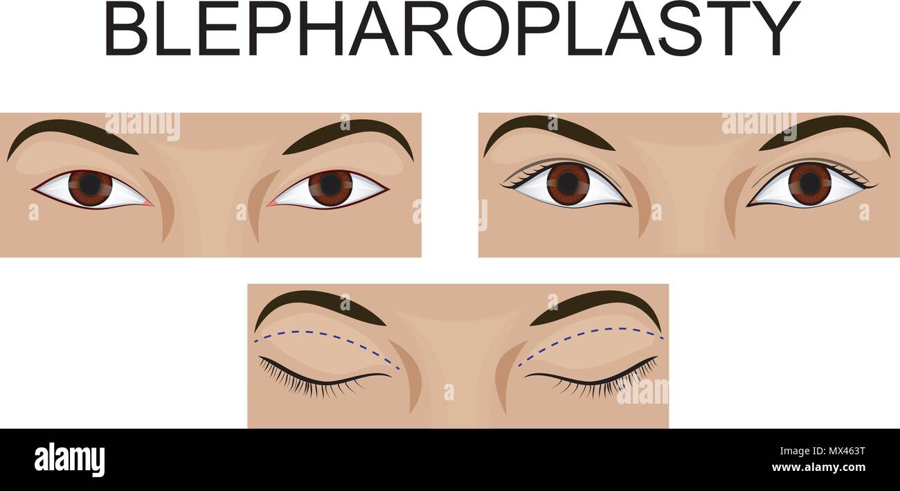 illustration of upper eyelid blepharoplasty, before and after Stock ...