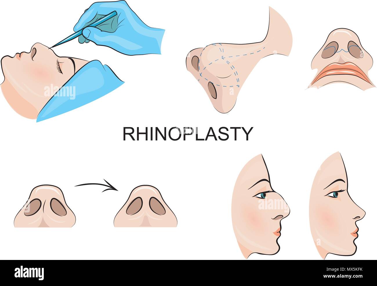 illustration of rhinoplasty. cosmetic surgery. aesthetic medicine ...