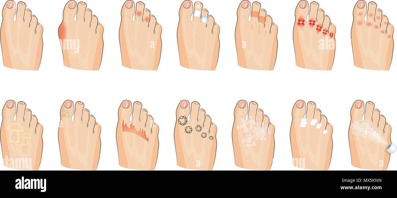 illustration of the various foot damage, inflammations Stock Vector ...