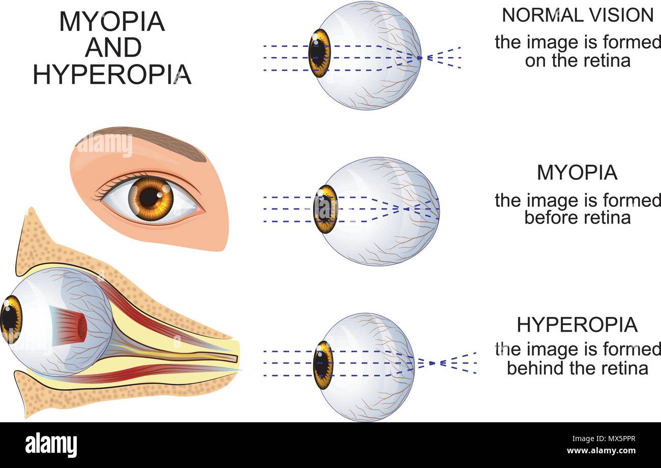 illustration of a healthy eye, the eye, myopia and hyperopia Stock ...
