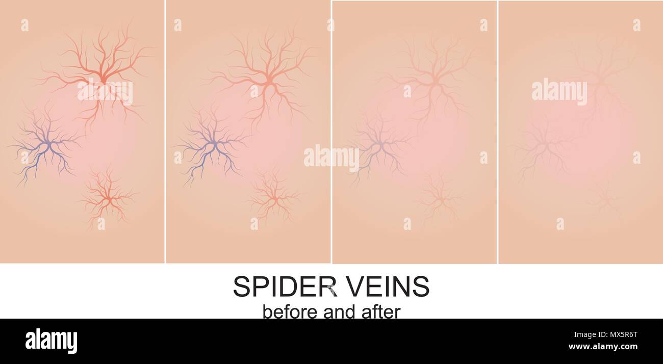 illustration of skin with spider veins. treatment. cosmetology Stock ...