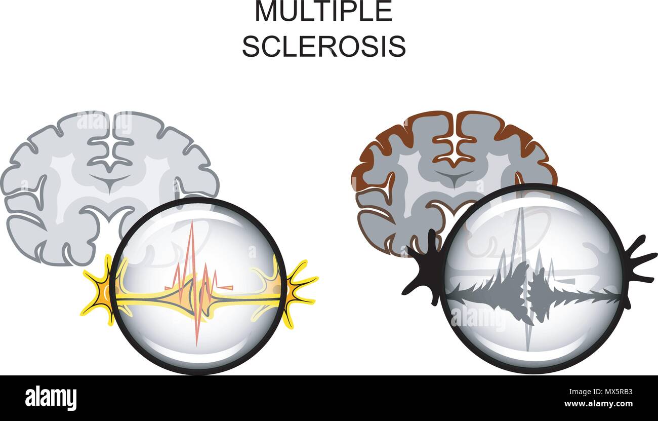 Multiple sclerosis brain hi-res stock photography and images - Alamy